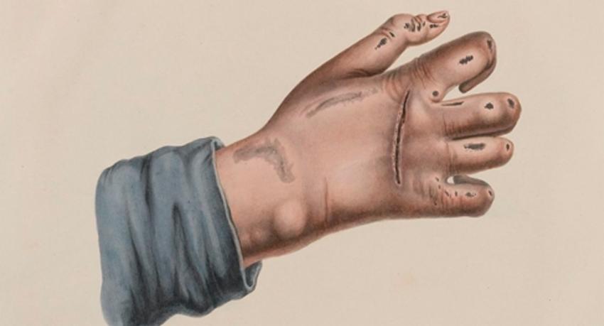 15% of Leprosy cases among school children this year