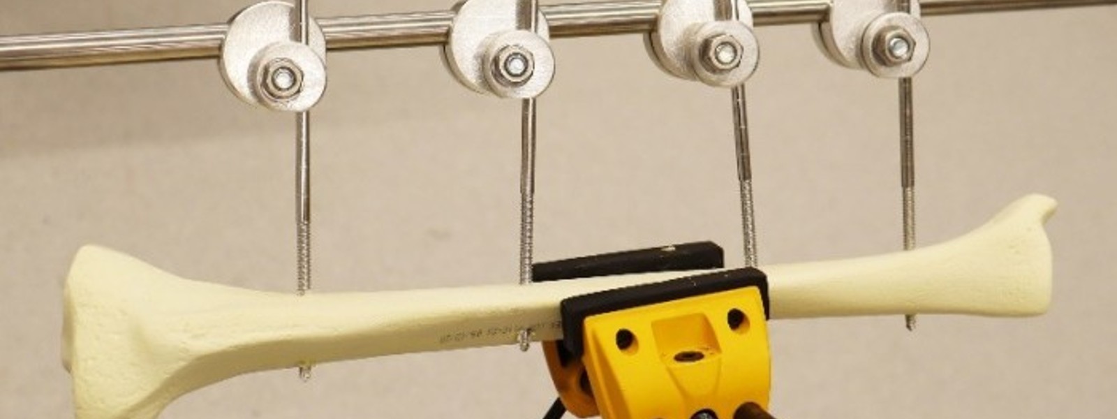 Affordable device for fixing broken bones piloted in Gaza, Sri Lanka ...